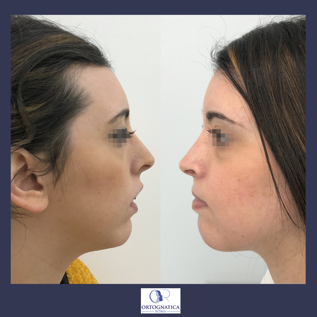 Beauty-full Chin: la tecnica innovativa per correggere il mento retruso