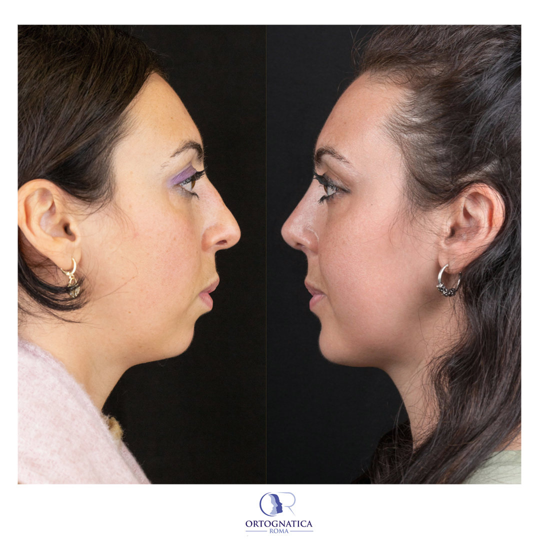 mento sfuggente - OrtognaticaRoma