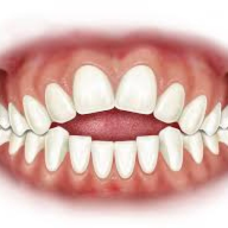 morso aperto - OrtognaticaRoma