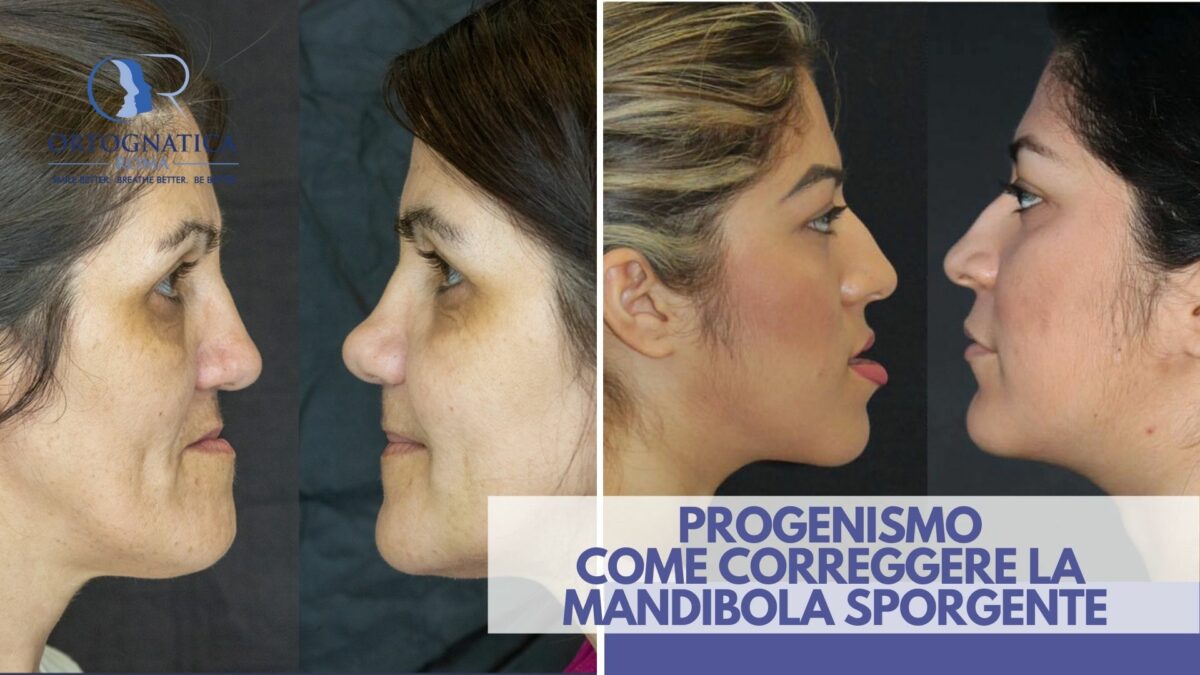 prognatismo mascellare Archives - OrtognaticaRoma