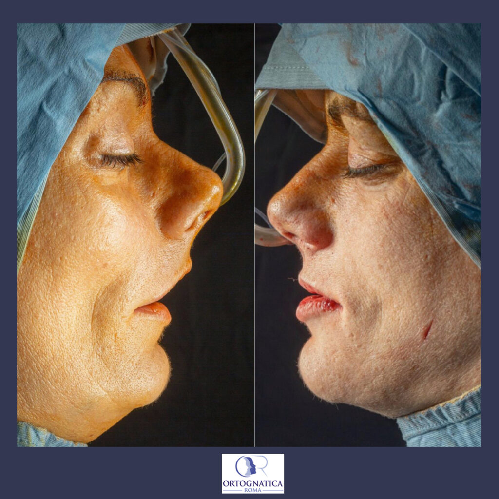 La Pappagorgia: eliminare il doppio mento