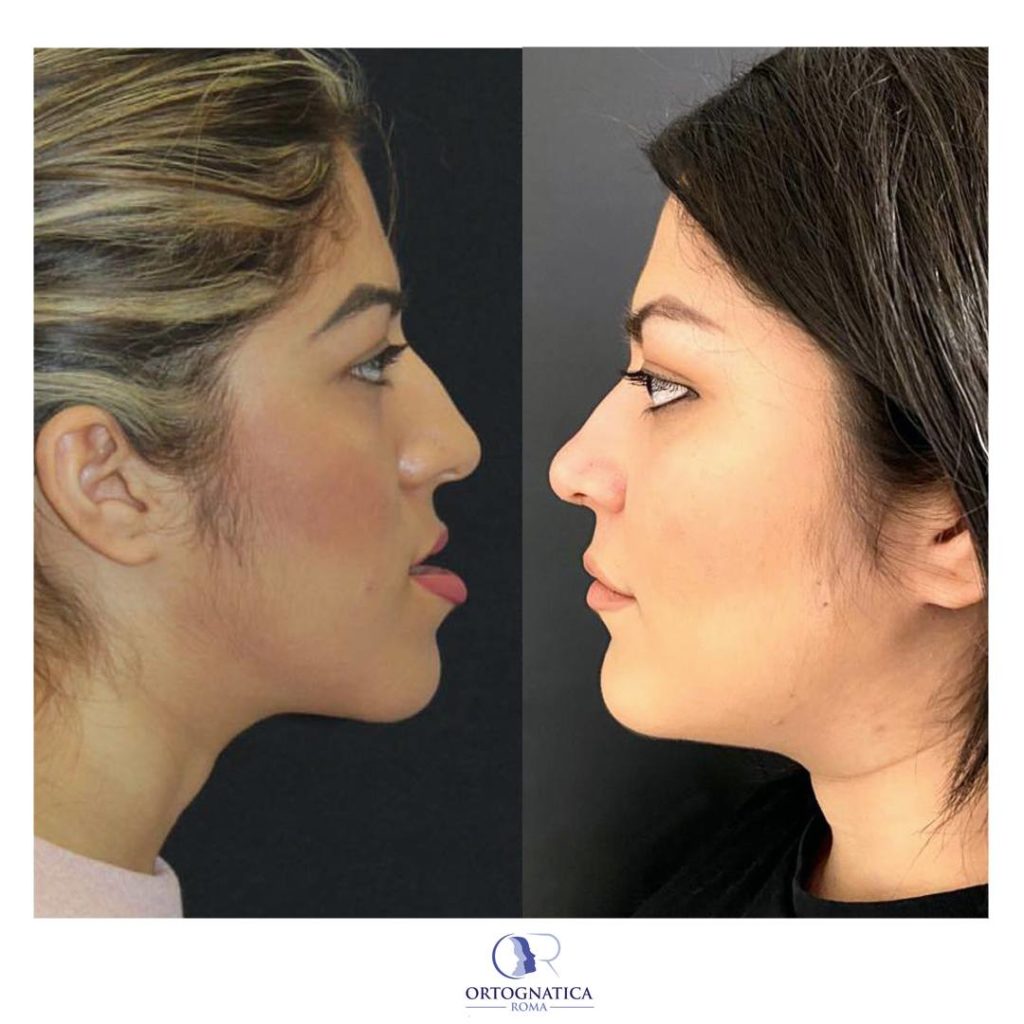 Progenismo: i mille modi per poterlo definire - OrtognaticaRoma