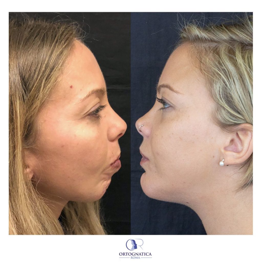 retrogenia - OrtognaticaRoma