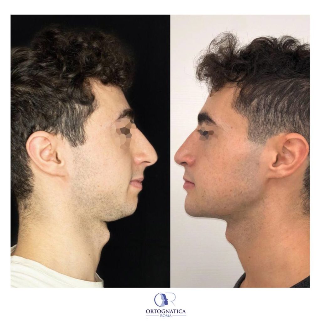 II classe - OrtognaticaRoma