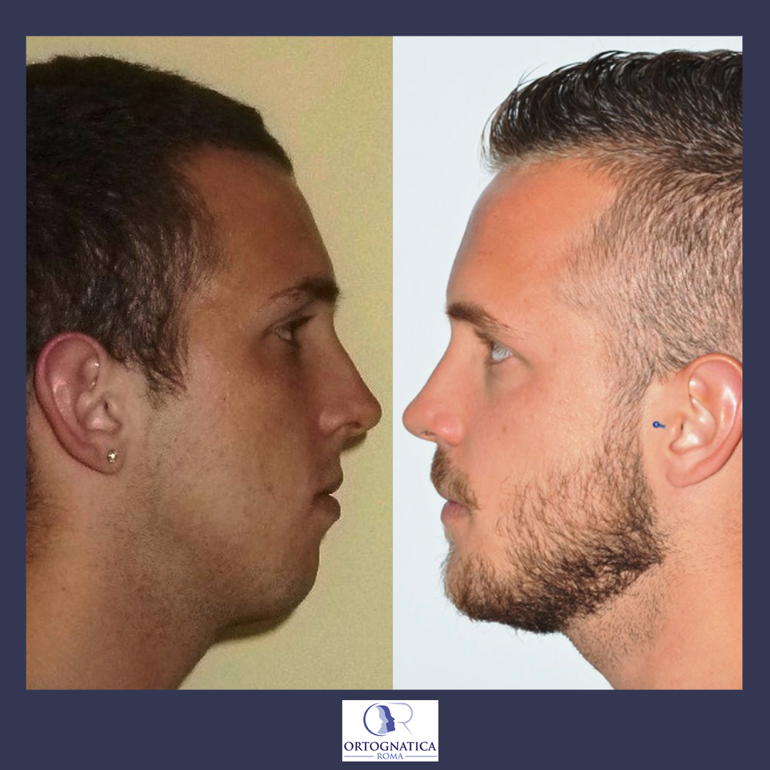 II classe - OrtognaticaRoma