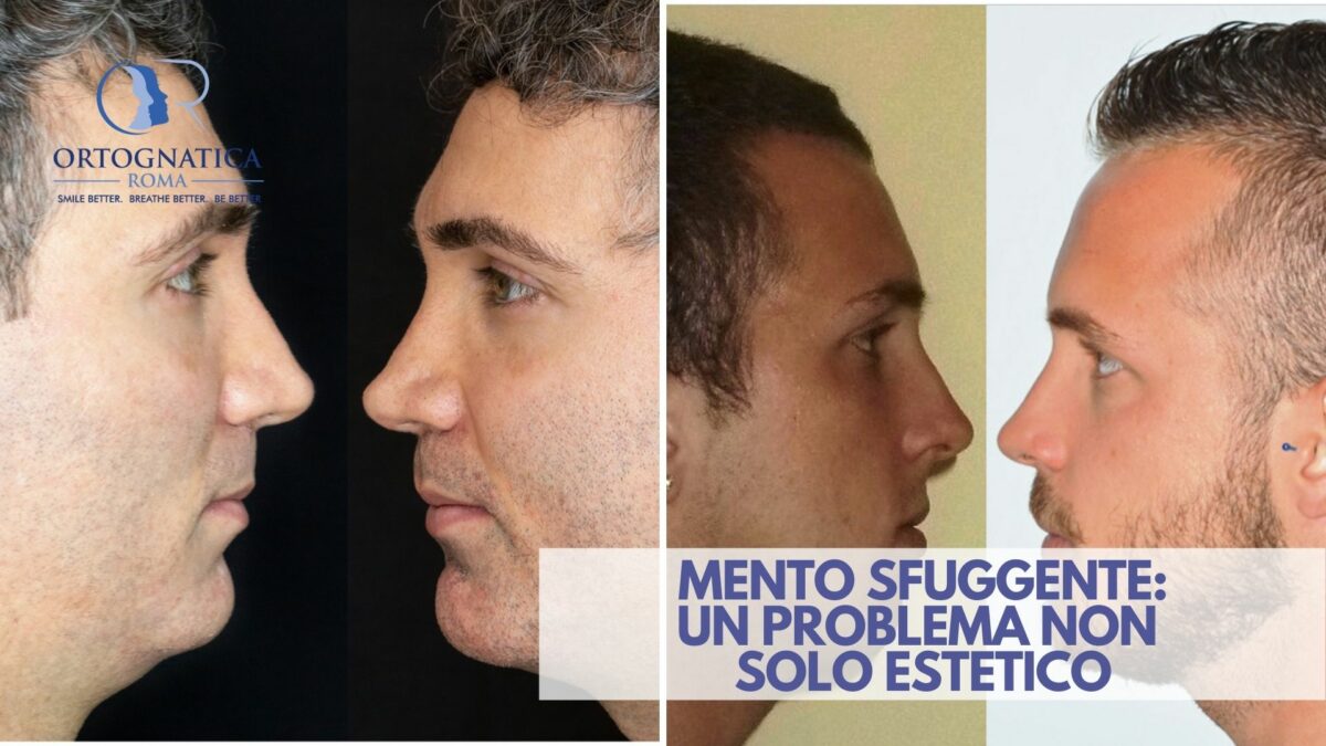 mento retruso Archives - OrtognaticaRoma