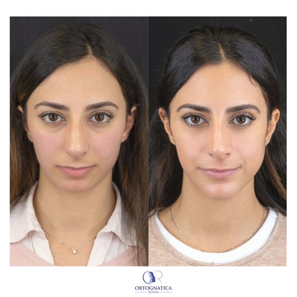 Chirurgia ortognatica: 6 motivi per affrontarla - OrtognaticaRoma
