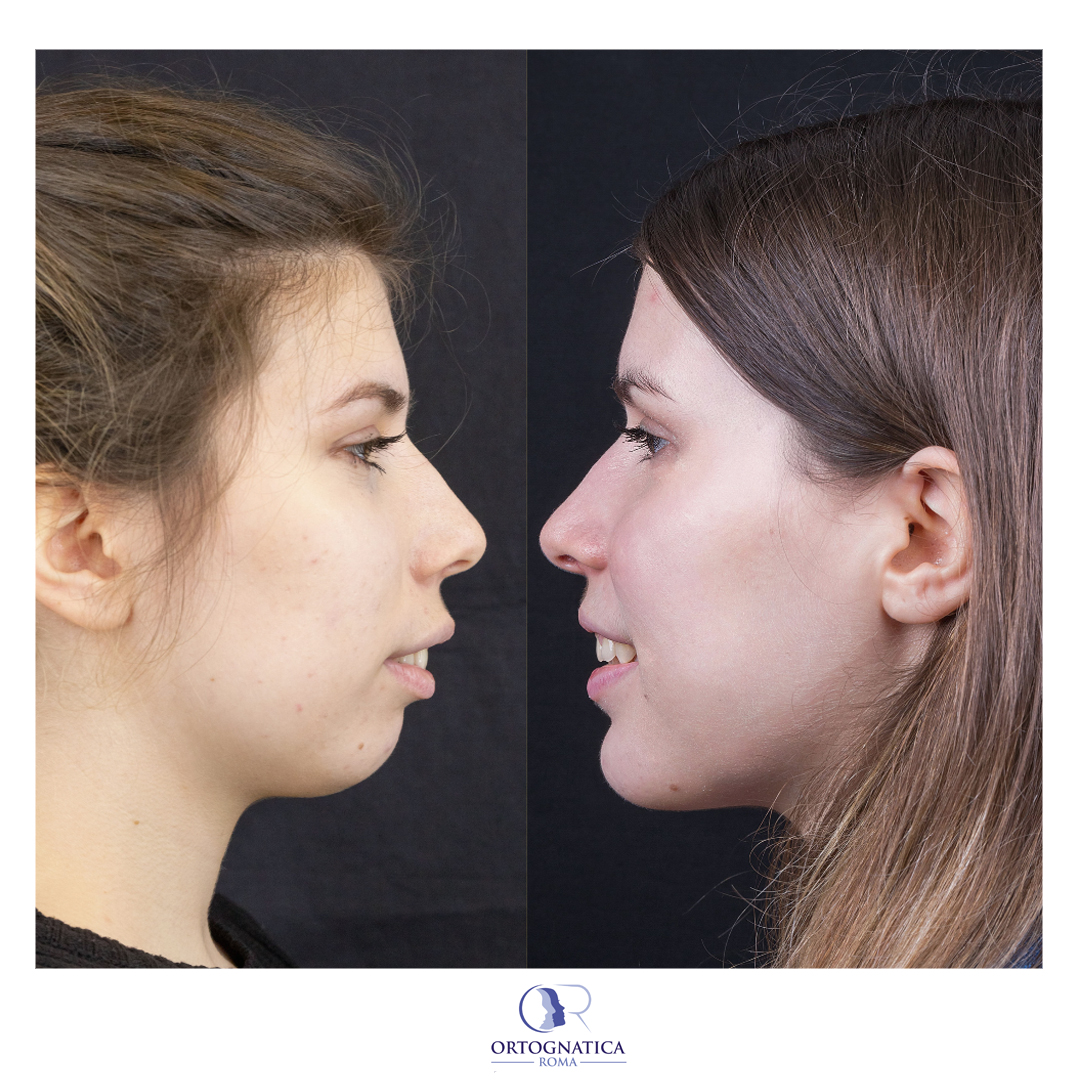 Genioplastica: come rifare il mento - OrtognaticaRoma