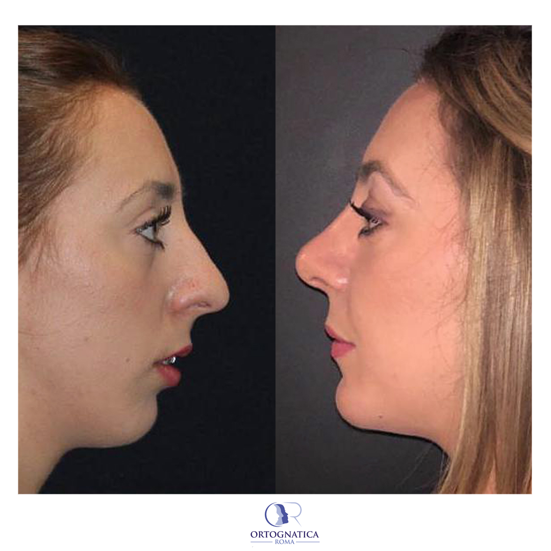Genioplastica: come rifare il mento - OrtognaticaRoma