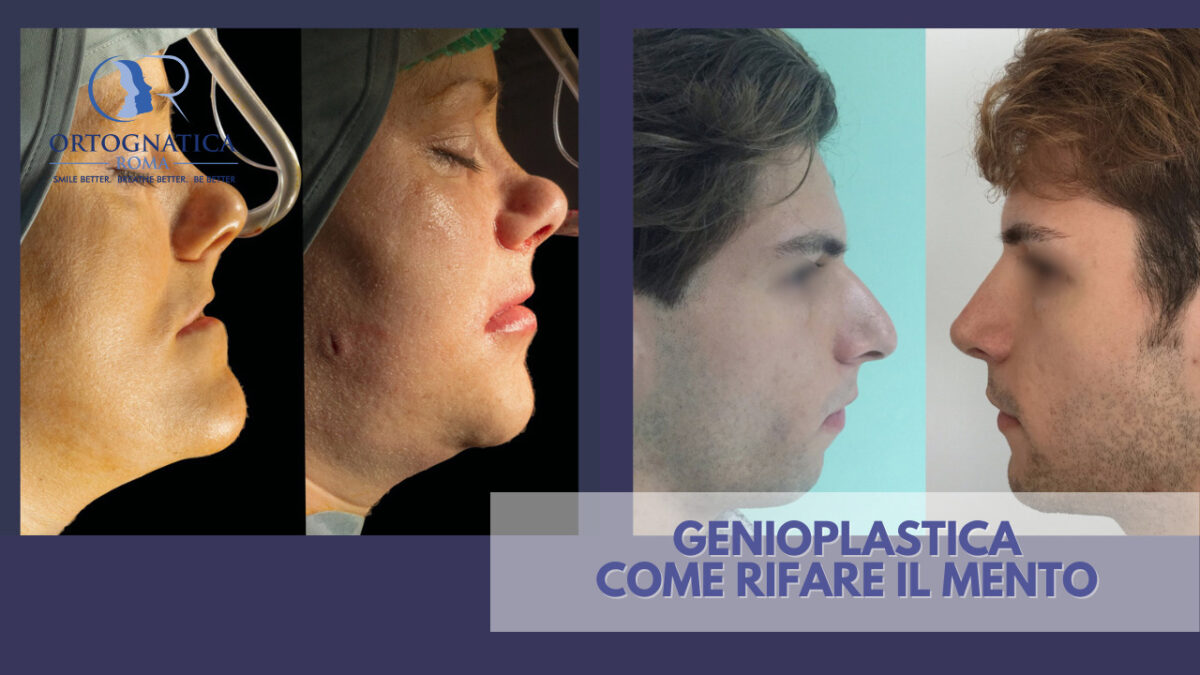 Genioplastica: come rifare il mento - OrtognaticaRoma