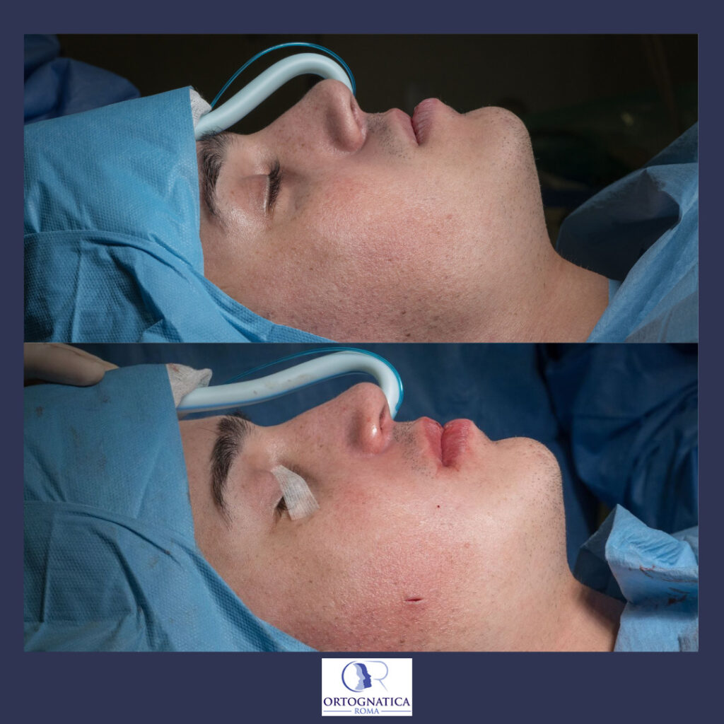 La chirurgia bimascellare e la chirurgia ortognatica - OrtognaticaRoma