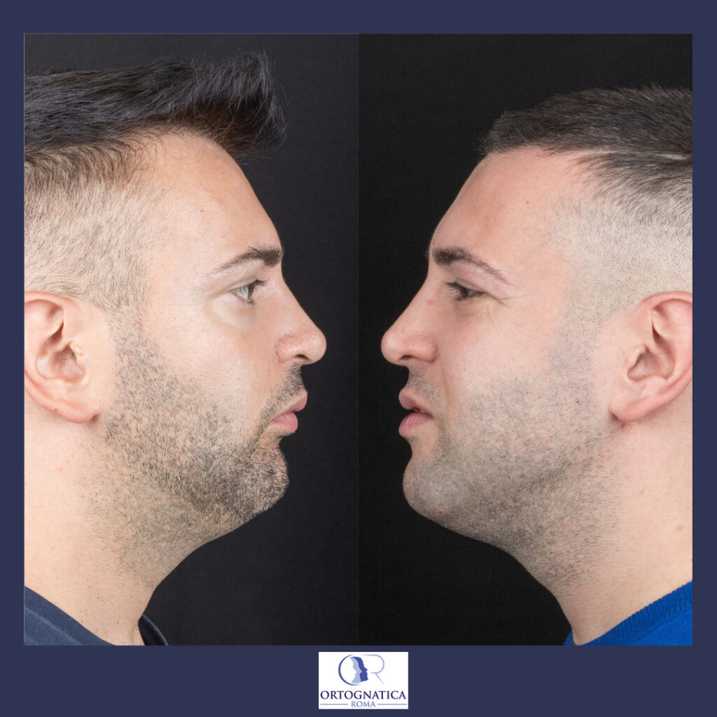 La chirurgia bimascellare e la chirurgia ortognatica - OrtognaticaRoma